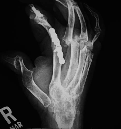Medical Apparatus Imaging Guide Joint Arthroplasty