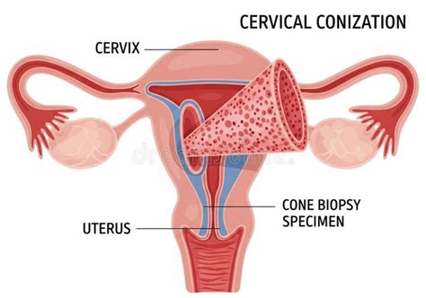 Illustration Depicting Cervical Conization A Medical Procedure The