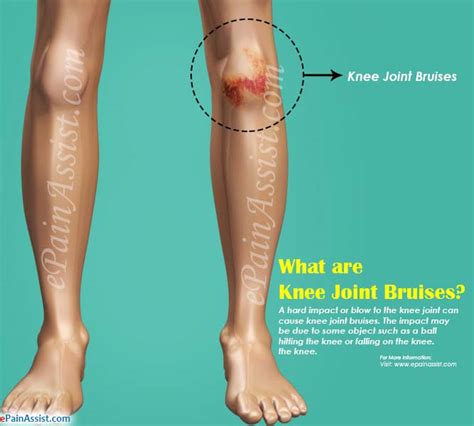 Knee Joint Bruisescausessymptomstreatmentrecoveryprevention