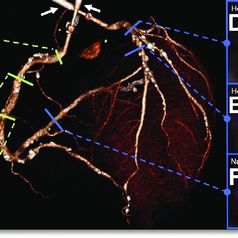 Traditional And Attenuation Pattern Based Plaque Classifi Cation