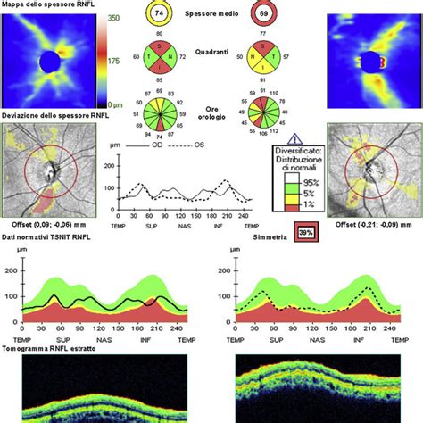Retinal Nerve Fiber Layer Thickness Analysis Report Download