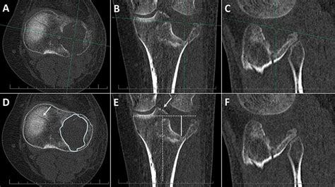 Multiplanar Reconstruction Mpr Of The Knee Joint From Axial Ct Scan