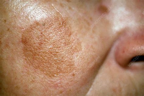 Lentigo Stock Image C0222097 Science Photo Library