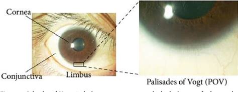 Figure 1 From Limbal Stem Cell Deficiency Special Focus On Tracking