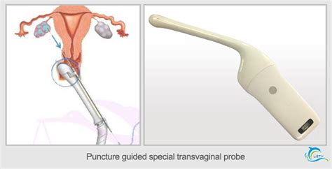 Wireless Ultrasound Transvaginal Probe