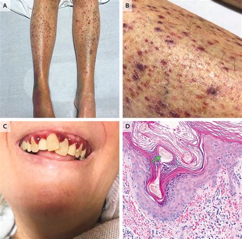 Follicular Hyperkeratosis Vitamin A Deficiency