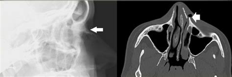 Facial Bone Fractures Evaluated On Plain Radiography And Ct Scan