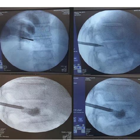 Vertebroplasty For Thoracic 11 Vertebral Fractures Under The Guidance Download Scientific