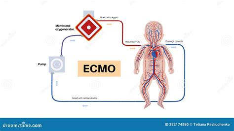 Extracorporeal Membrane Oxygenation Cartoon Vector 332174903