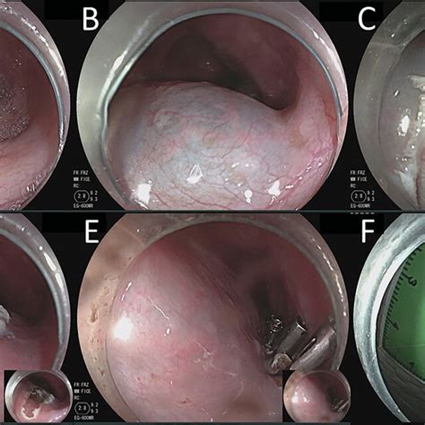The Key Steps Of Eftr A Endoscopic View Of E Gist B Submucosal