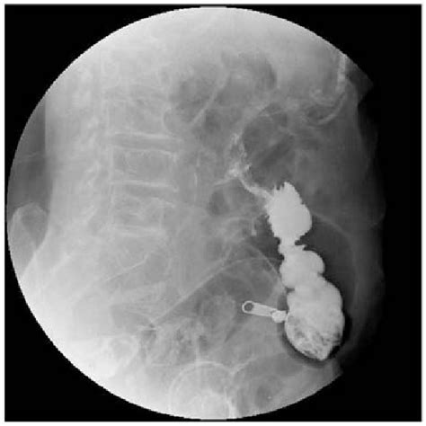 Improvement Of The Dilatation Of The Colon After Decompression And