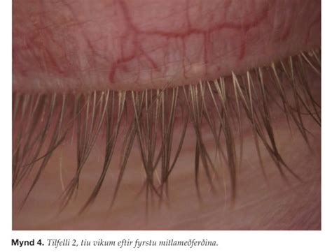 Squamous Blepharitis
