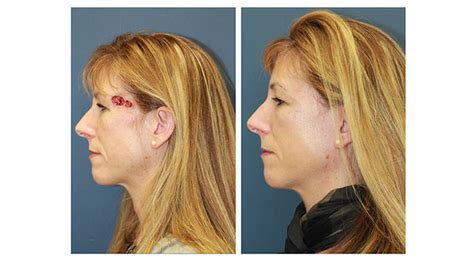 Facial Reconstruction Before And After Gallery Mount Sinai New York