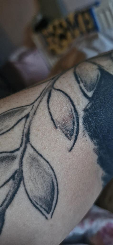 Suspected Shingles Rdermatologyquestions