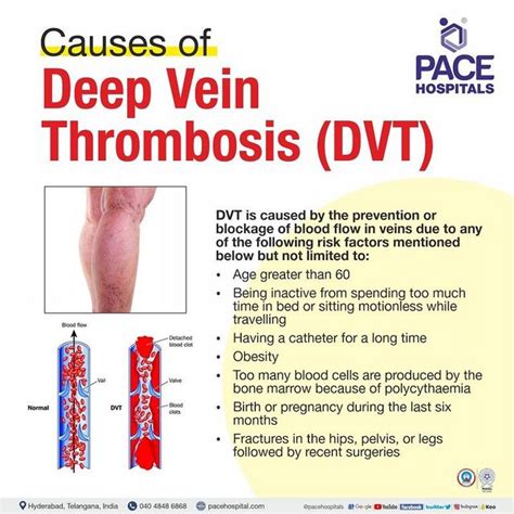 Deep Vein Thrombosis Dvt Symptoms Causes And 48 Off