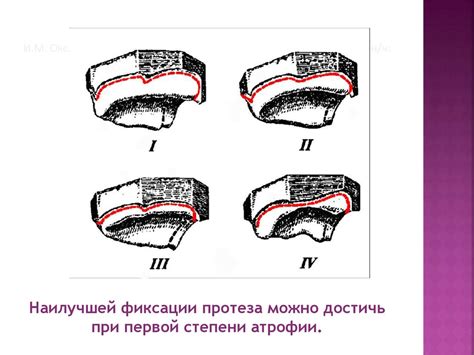 Ортопедическое лечение при полном отсутствии зубов презентация онлайн