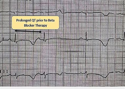 Marked T Wave Alternans With A Prolonged Qt Interval Prior To Download Scientific Diagram