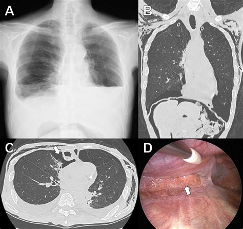 Co Occurrence Of Bilateral Pneumothorax And Pneumoperitoneum Bmj Case Reports