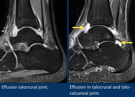 Ankle Effusion X Ray