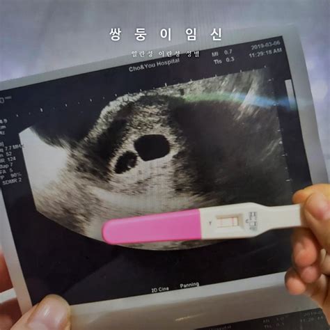 쌍둥이 임신 아기집 두개는 일란성 Or 이란성 네이버 블로그