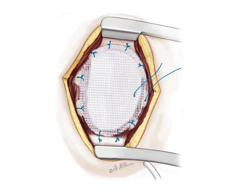 Chest Wall Resection And Reconstruction Baylor Medicine