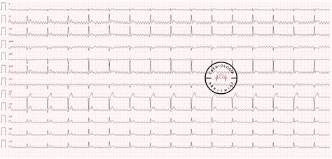 Flutter Auricular Ecg 2025