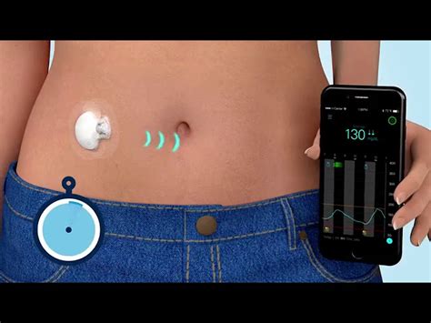 What Is Continuous Glucose Monitoring CGM