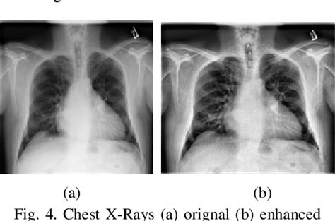 Figure 1 From Computer Aided System For Pneumothorax Detection Through Chest X Ray Images Using