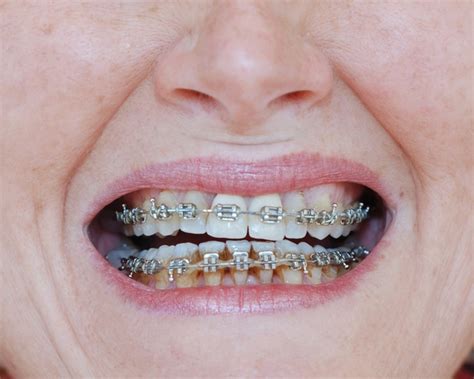 How To Prevent Teeth Staining While Wearing Braces — Orthodontic