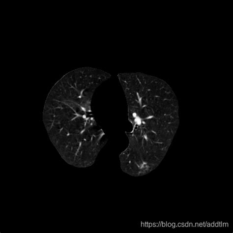从dicom的xml文件中获取结节坐标并生成maskdicom怎么查结节的值 Csdn博客