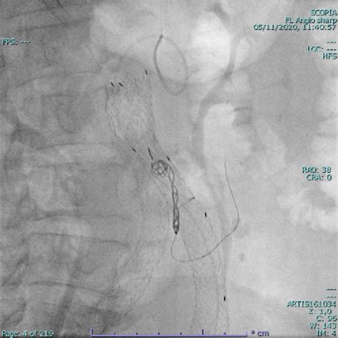 Embolization Of The Superior Mesenteric Artery With Coils Axium Coils