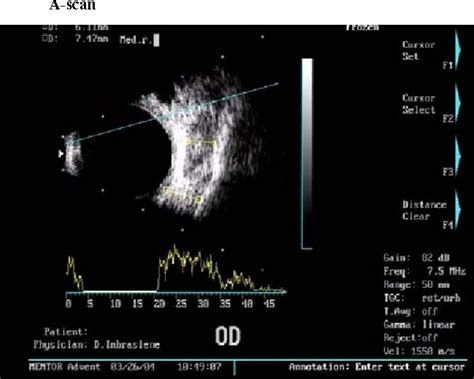 Figure 2 From Orbital Ultrasonography For Diagnosis And Evaluation Of