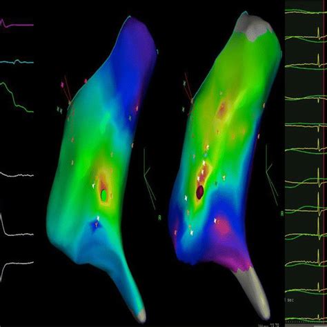 Pvc Origin Classified According To Successful Ablation Site Rvot Download Scientific Diagram