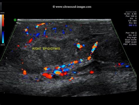 Epididymitis Ultrasound