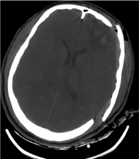 Left Fronto Temporal Decompressive Craniotomy Note Copyright © 2013 Download Scientific
