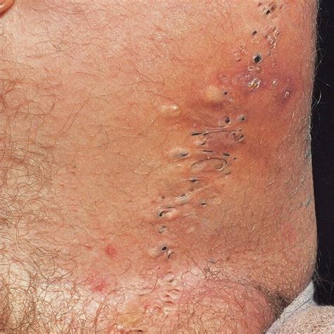 Nevus Comedonicus Photos