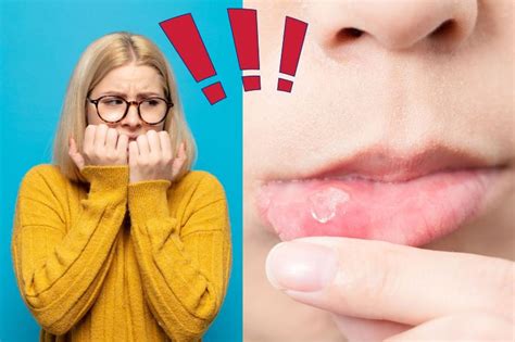 Afte In Bocca I Rimedi Per Farle Passare Prima Possibile Newssaluteit