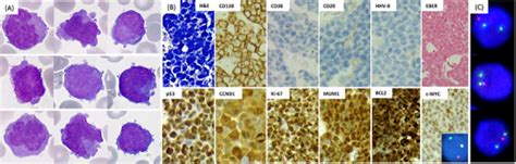 Primary Plasmablastic Plasma Cell Leukemia A Diagnostic Conundrum Pmc