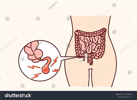 Closeup Human Body Inflamed Appendix Person Stock Vector Royalty Free 2190869749 Shutterstock