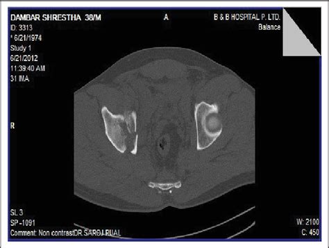 38 Y M Axial Ct Image Shows T Shaped Fracture Of Right Acetabulum Download Scientific Diagram