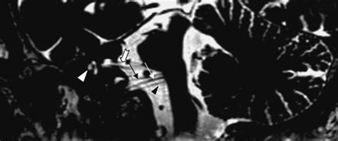 Mr Imaging Of The Cisternal Segment Of The Posterior Group Of Cranial