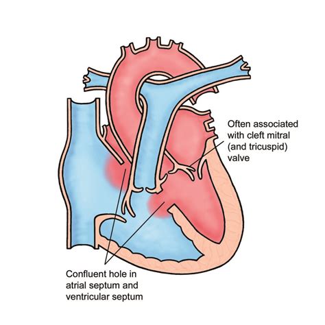 Repaired Atrioventricular Septal Defect Avsd Leeds Teaching