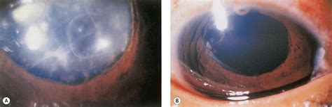 Role Of Surgery In The Patient With Uveitis Clinical Tree
