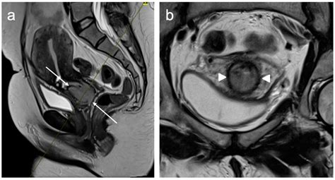 Sagittal T2wi A Shows A Well Defined Intermediate Signal Intensity Download Scientific