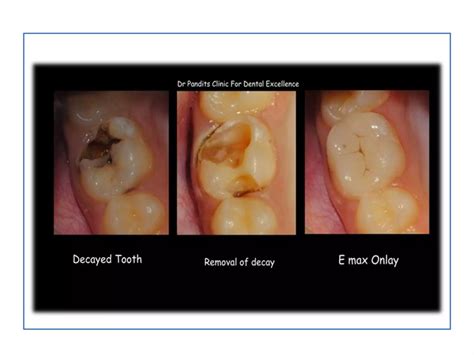 Direct And Indirect Pulp Capping Pptx Dental Health Diseases And