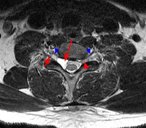 Brachial Plexopathy Radsource
