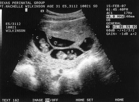 Quintuplets Ultrasound Real Mayorga Quintuplets Multiple Births