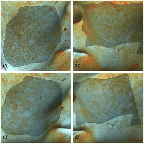 Comparison Between Both Sides Regarding Melanin Pigmentation Measured Download Scientific
