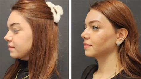 Step By Step Double Jaw Surgery Before After