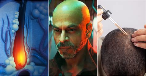 Have Scientists Found The Cure To Prevent Male Balding Here S The Truth